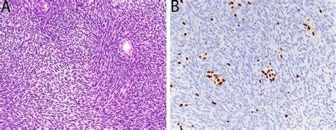 Malignant Peripheral Nerve Sheath Tumor Is A Fascicular Spindle Cell