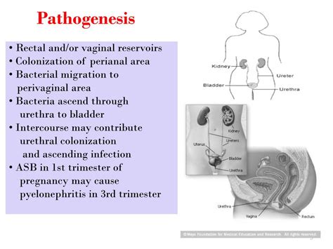 Ppt Pyelonephritis Powerpoint Presentation Free Download Id 5642642