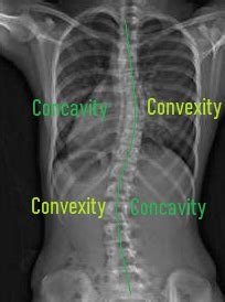 Exercises To Straighten Spine Scoliosis Posture Direct
