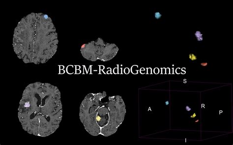 New Dataset Mri Dataset Of Metastatic Breast Cancer To The Brain With