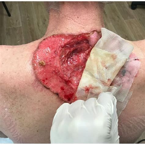 Sharply Demarcated Friable Ulcer On The Upper Mid Back Download