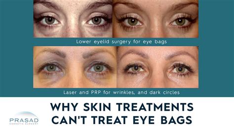 Why Prp Or Lasers Dont Work For Puffy Under Eye Bags