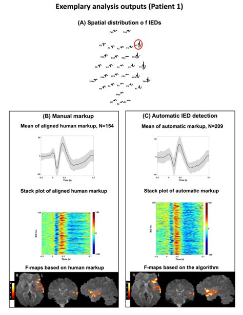 A Representative Illustration Of Automatic Spike Detection A And Download Scientific Diagram