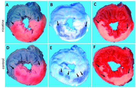 Representative Left Ventricularslices Showing The Risk Zone Infarct Download Scientific