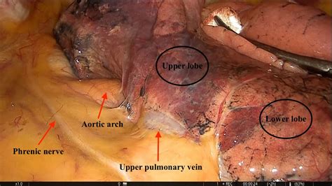 Vats Left Upper Lobe Apical Trisegmentectomy Youtube