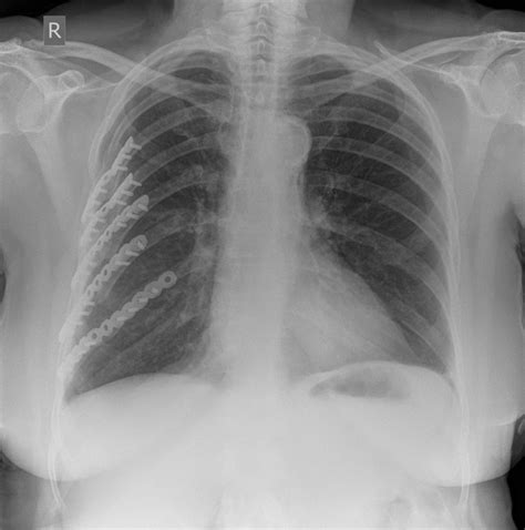 Rib Fractures Pacs