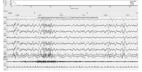 Example Of Cyclic Alternating Pattern Cap Subtype A2 Mixture Of