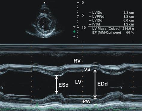 Quantitative Methods In Echocardiography—basic Techniques Thoracic Key