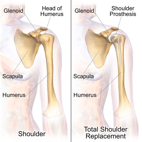 Shoulder Replacement Expert Care Aptiva Health