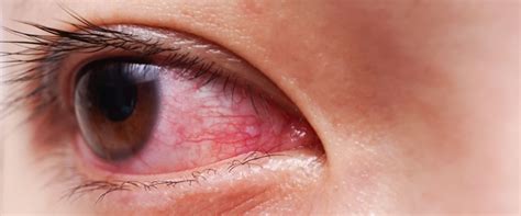 What Causes Red Eyes Like Blood At Jessica Zelman Blog