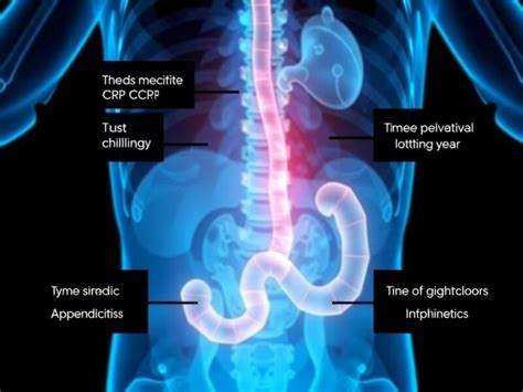 Crp Levels In Appendicitis Diagnostic Value And Clinical Significance