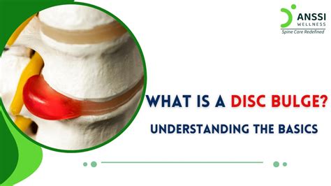 What Is A Disc Bulge Understanding The Basics Anssi Wellness