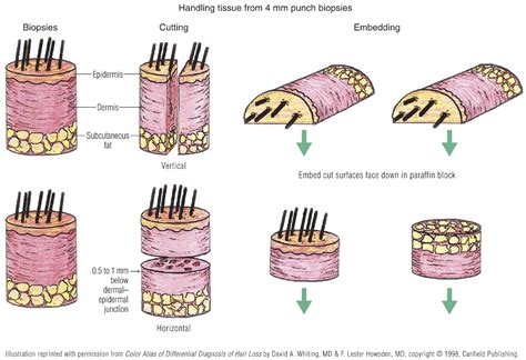 Does Scalp Biopsy Cause Hair Loss At Trudi Abbas Blog