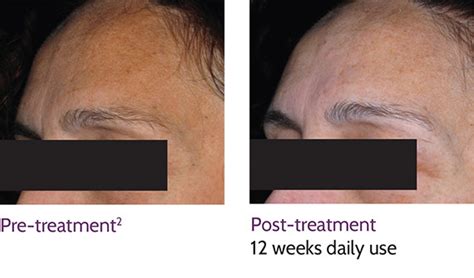 Neoretin Dermocosmètica