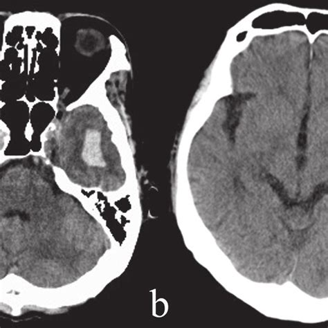 Classification According To Borden Et Al 5 And Cognard Et Al 6 Of Download Table