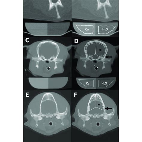 A Osteodensitometry Ct Image With 10mm Slice Width Of The Third