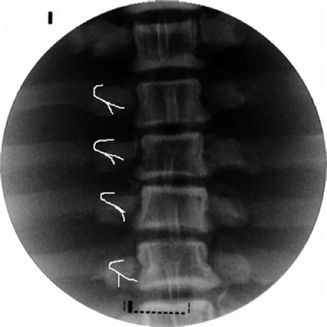 Percutaneous Neural Destructive Techniques Anesthesia Key