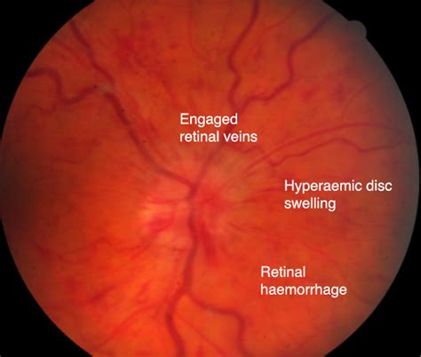 Visual Field Defects Double Vision And Optic Disc Swelling