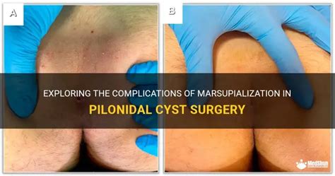 Exploring The Complications Of Marsupialization In Pilonidal Cyst Surgery Medshun
