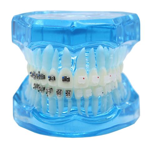 Blue Braces For Teeth