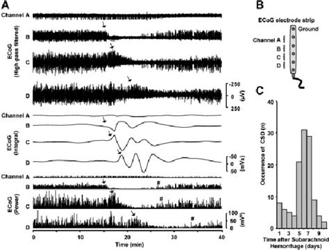 Subdural Electrocorticography ECoG A A Representative Download Scientific Diagram