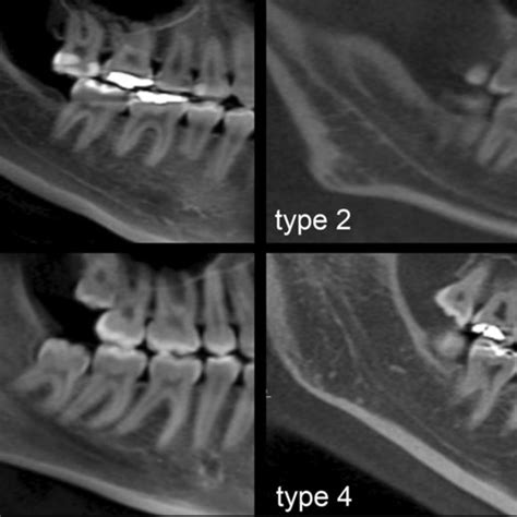 Linear Measurements Obtained From Cone Beam Computed Tomography Download Scientific Diagram