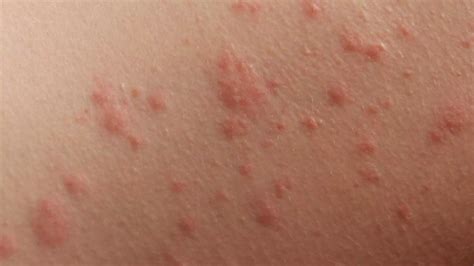 Red Rash On Helmet At Jeri Burris Blog