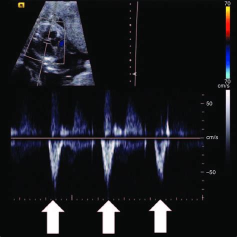 Pulsed Wave Doppler Evaluation Of Mitral Valve Inflow The Doppler Download Scientific Diagram