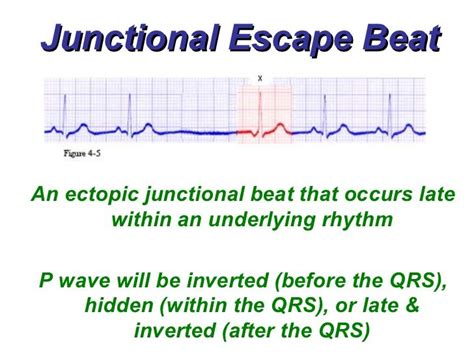 Junctional Escape Beat An Ectopic Junctional Beat That Occurs Late
