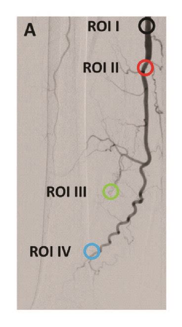 A 57 Year Old Patient With Pad Rutherford 3 Pad Classification And An Download Scientific