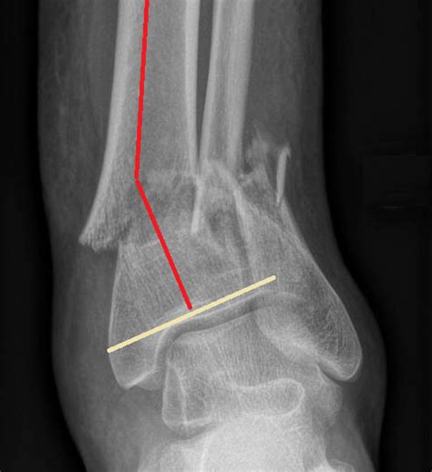 Describe A Fracture Pattern Over The Phone Orthopaedia