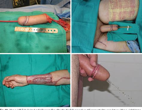 Successful Phalloplasty Results