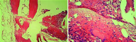 A A Bone Marrow Biopsy Showed Slightly Hypercellular Marrow With