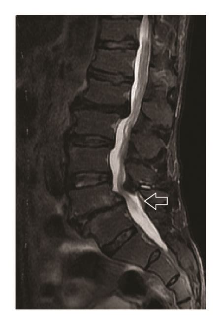 P Acnes Identified And Isolated From A Nonpyogenic Intervertebral
