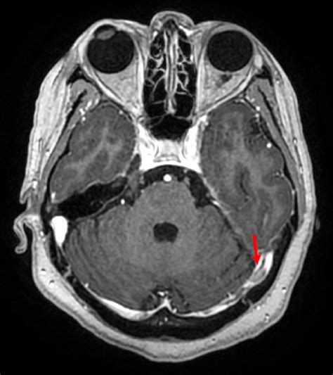 axial enhanced 3 dimensional spoiled gradient echo image showing a