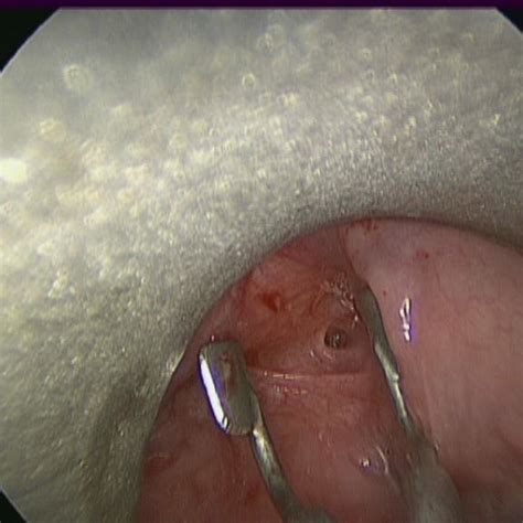 Internal Opening Over Left Pyriform Fossa After Diathermised Download Scientific Diagram