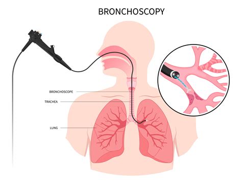 Flexible Bronchoscopy Medical Associates Of Northwest Arkansas