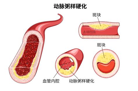 动脉粥样硬化（标注版） 医学插画