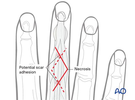 Dorsal Approaches To The Proximal Interphalangeal Joint