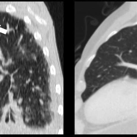 Single Photon Emission Computed Tomography Spect Left And Spect Ct Download Scientific