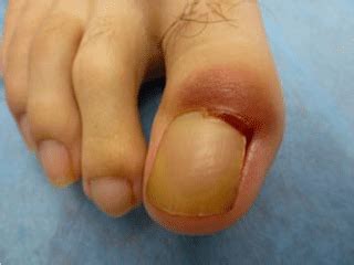 Retronychia Treated With Proximal Nail Avulsion Two Cases Successfully
