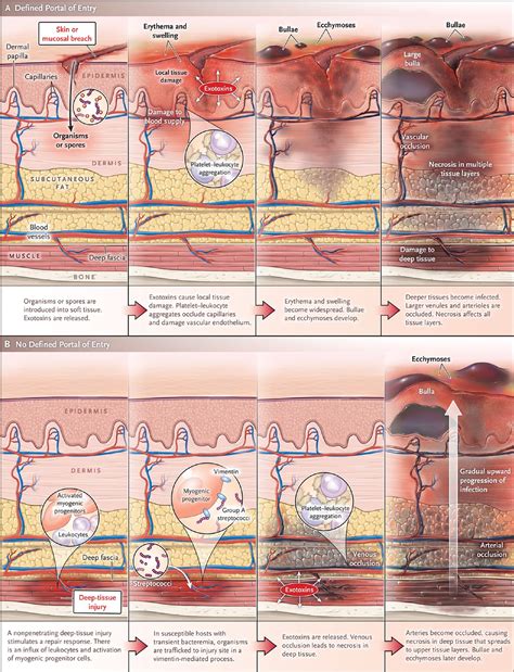 Pediatric Necrotizing Fasciitis Journal Of The Pediatric Orthopaedic