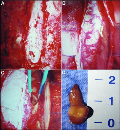 Surgical Excision Of The Intramedullary Cyst A The Tough And Tense