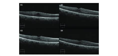 A Year Old Man Complained Of Visual Acuity Loss With Visual Download Scientific Diagram
