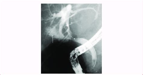 Leakage Associated With Mid Cbd Stricture Download Scientific Diagram