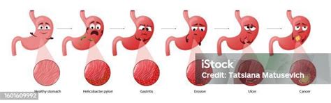 위장병 감정이 있는 만화 캐릭터 다이어그램 질병 헬리코박터 파일로리 위염 침식 궤양 암 교육용 해부학적 벡터 그림입니다 건강관리와 의술에 대한 스톡 벡터 아트 및 기타