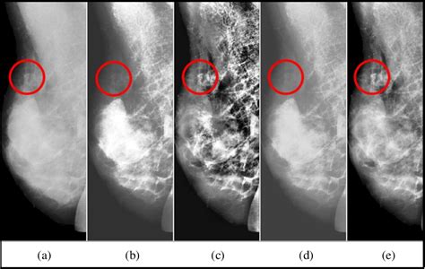 Figure 1 From Enhancing Detection Of Microcalcifications Using Fadhecal