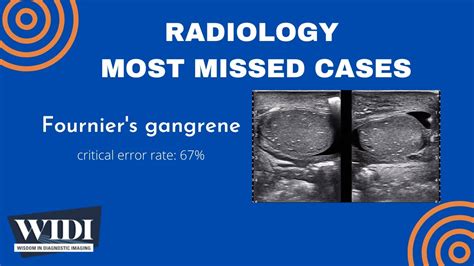 Fournier S Gangrene Pictures Fournier Gangrene Pictorial Review