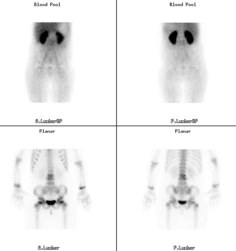 Nuclear Medicine PET Bone Scan