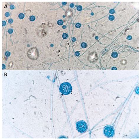 Lactophenol Cotton Blue Stain Bone Biopsy Culture A Septate Hyaline Download Scientific